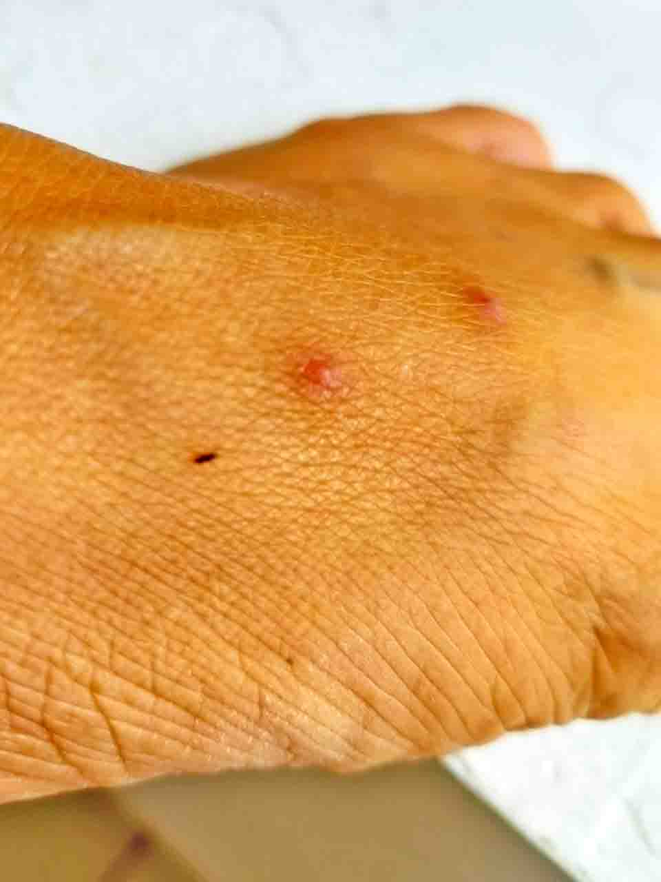 Bentol Merah Gatal Digigit Kutu Kucing? — Travel Diary of Lenny Lim